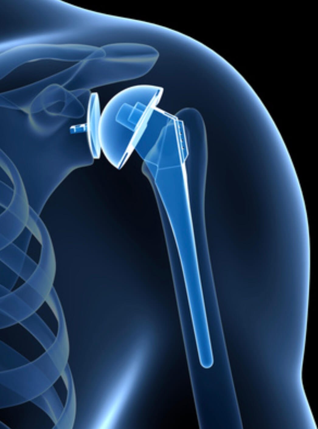 Anatomic Shoulder Replacement - Cyprus Orthopaedics